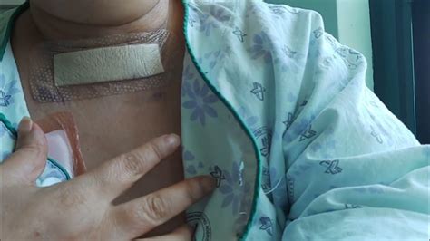 갑상선 암 수술 Youtube