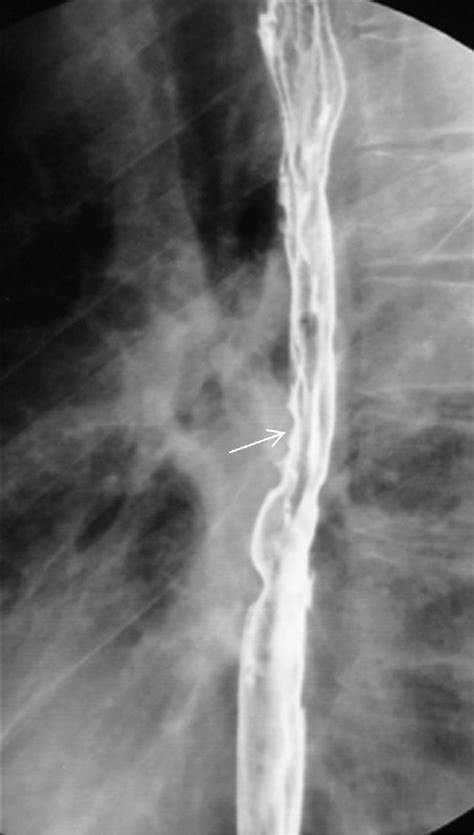 Barretts Esophagus Upright Lpo Image Of Double Contrast Barium