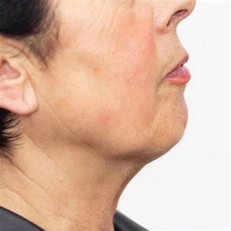 Non Surgical Chin Fat Removal Treatments Sisu Clinic Ireland