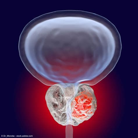 Acute Toxicity After Prostate Cancer Radiotherapy Increases Odds Of