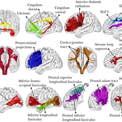 4 Left Tractography Of The White Matter Reconstructed Using Diffusion