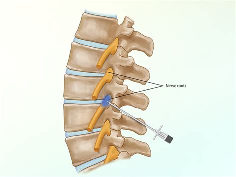 Spinal Injections Dr Utkarsh Agrawal