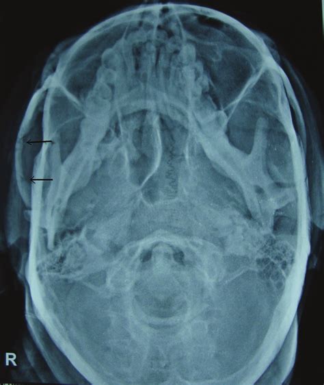 Zygomatic Arch Radiograph Zygomatic Complex Fractures In The Emergency