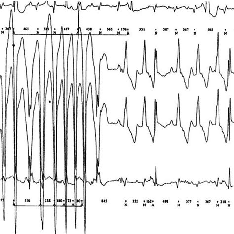 Pdf Implantation Of The New Medtronic Linq™ Loop Recorder In An