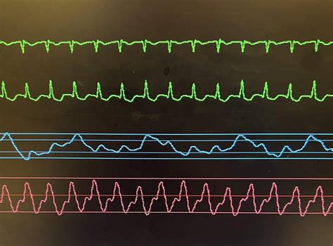 Anyone Know What Causes An Arterial Waveform Like This Its “backwards