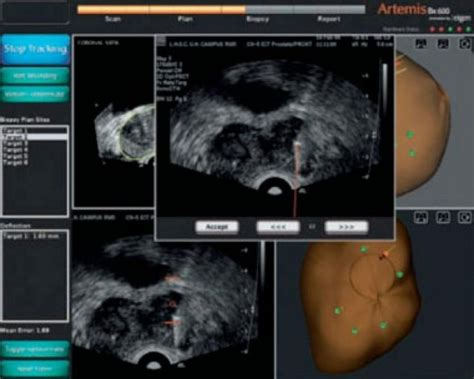 Mritrus Fusion Biopsies Why Mritrus Prostate Biopsy Sperling Prostate Center