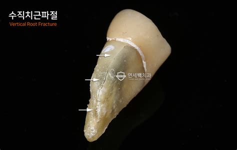 연세백치과 칼럼 수직치근파절 치아 뿌리에 금이 갔어요