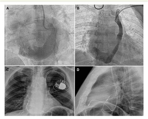 Table 1 From Ehra Expert Consensus Statement And Practical Guide On Optimal Implantation