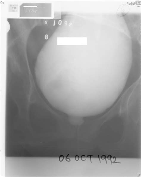 Cystogram Done On 06 October 1992 Revealed A Large Capacity Bladder Download Scientific