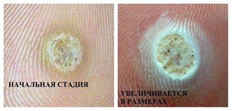 ﻿Как выглядит подошвенная бородавка фото 35 фото