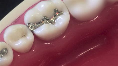 Class 2 Amalgam Restoration