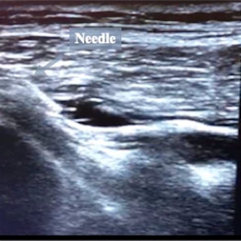 Ultrasound Guided Serratus Anterior Plane Block Ultrasound Transducer