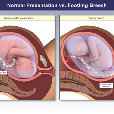 Normal Vs Retrocecal Appendix Trial Exhibits Inc