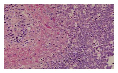 Prostatic Tissue With Polymorphonuclear Cells Culture Positive For Mrsa Download Scientific