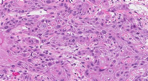 Squamous Cell Carcinoma Of The Skin Ottawa Atlas Of Pathology
