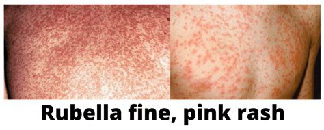 Rubella Causes Mode Of Transmission Symptoms And Treatments