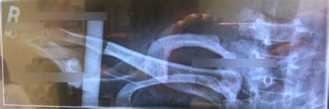 Clavicle X Ray Diagram Quizlet