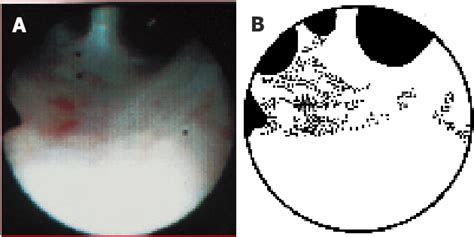 Figure 1 From Peroral Cholangioscopy For Non Invasive Papillary Cholangiocarcinoma With