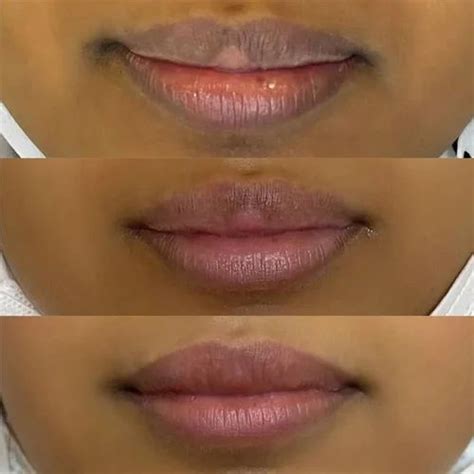 Lip Lighting Laser Treatment In Chennai In Chennai Id 2850487996212