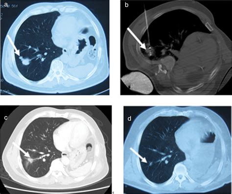 Microwave Ablation For Lung Cancer Patients With A Single Lung