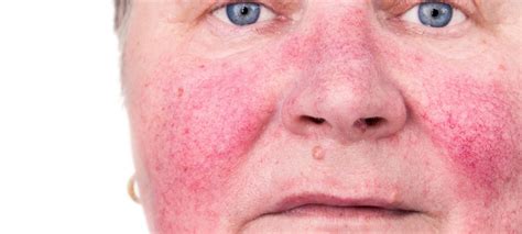 Top Causes And Treatments For Rosacea Rosacea
