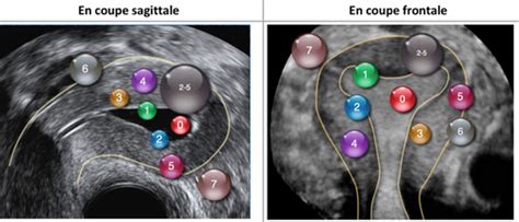 Fibromes Classification Figo Flashcards Quizlet