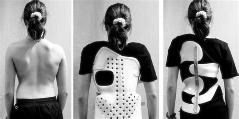 Сколиоз 4 степени лечение спец упражнения операция и ее последствия фото патологии