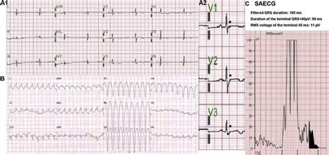 Current And State Of The Art On The Electrophysiologic Characteristics