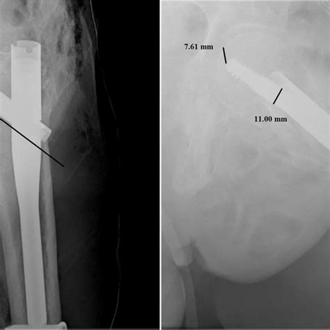 Cut Out In Relation To Tip To Apex Distance 14 Download Scientific Diagram