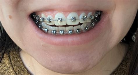 New Wires At 6 Week Mark 2nd Visit Rbraces