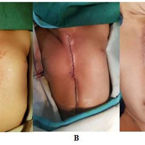 Summary Of Seven Case Reports Presented With Different Types Of Sternal Download Scientific