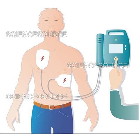 Automated Defibrillator Stock Image Science Source Images Automated Defibrillator Stock Image Science Source Images