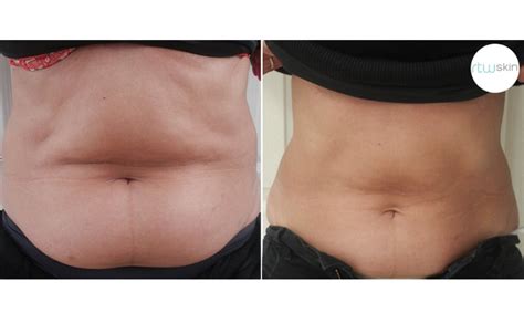Cryolipolysis Coolsculpting Information
