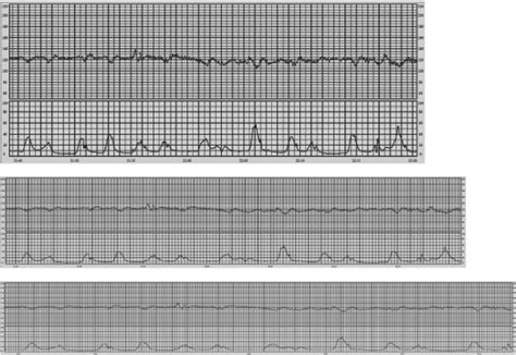 Pseudosinusoidal Pattern External Fetal Heart Rate Monitoring At 1