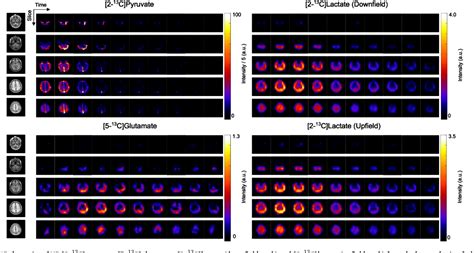 Hyperpolarized [2 13c]pyruvate Mr Molecular Imaging With Whole Brain Coverage Semantic Scholar