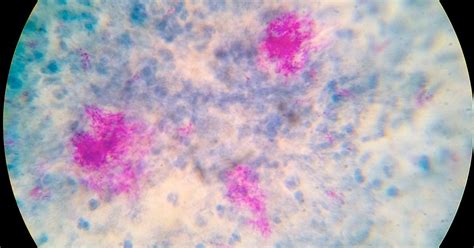 Acid Fast Staining Ziehl Neelsen Kinyoun And Interpretation Sean Schepers