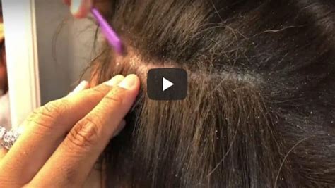 Dandruff Scraping Videos Have Taken Over Pimple Popping As The Most Grossly Satisfying Videos On