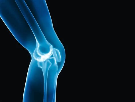 Osteoartritis Simptomi Liječenje I Prevencija Poliklinika K Centar