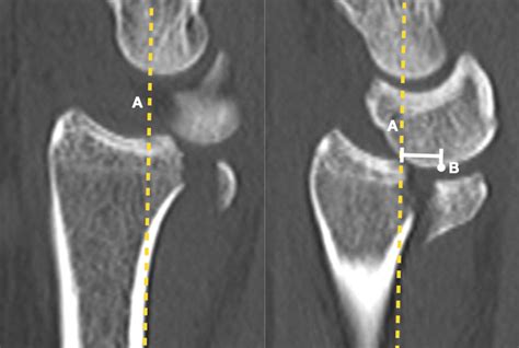Volar Lunate Facet Fractures Of The Distal Radius Fracture Mapping