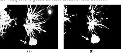 Figure 5 From An Improved Pulmonary Nodule Detection Scheme Based On