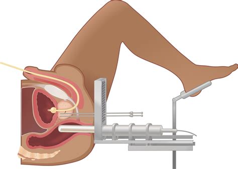 Brachytherapy In Iran Medpersia Medical Tourism