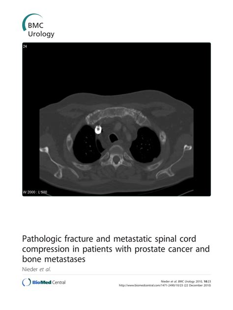Pdf Pathologic Fracture And Metastatic Spinal Cord Compression In Patients With Prostate