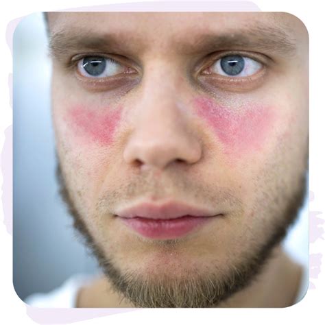 Lupus Treatment Cairns