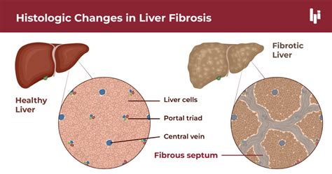 Navigating Liver Fibrosis Innovations In Imaging And Detection