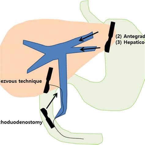 Eus Guided Versus Ercp Guided Biliary Drainage For Primary Treatment Of Distal Malignant Biliary
