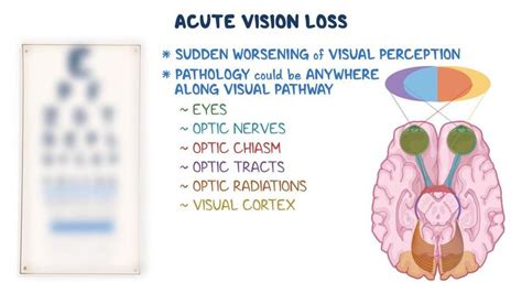 Approach To Acute Vision Loss Clinical Sciences Osmosis Video Library