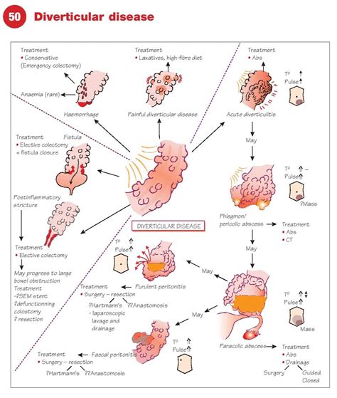 Diverticular Disease Symptoms Causes Treatment And Diet