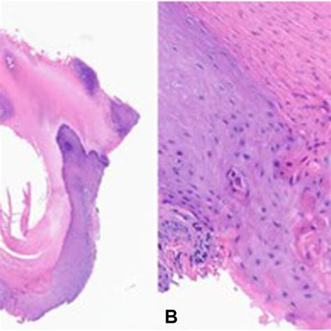 Punch Biopsy Of A Punctate Porokeratosis Lesion On The Left Foot A Download Scientific