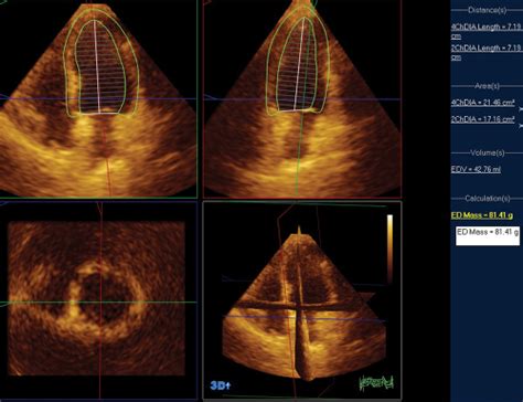 Lv Apical Mass