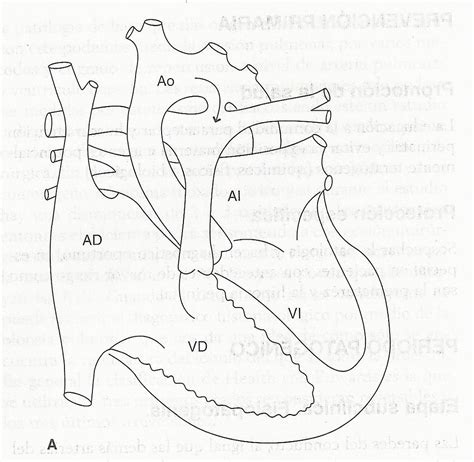 Persistencia Del Conducto Arterioso
